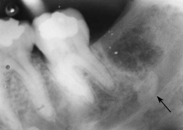 Common Complications Associated With Oral Surgery - Atlanta Celebrity News